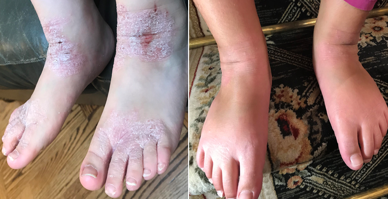 FDA Approves "Life-Changing" Biologic for Teens with Severe Eczema